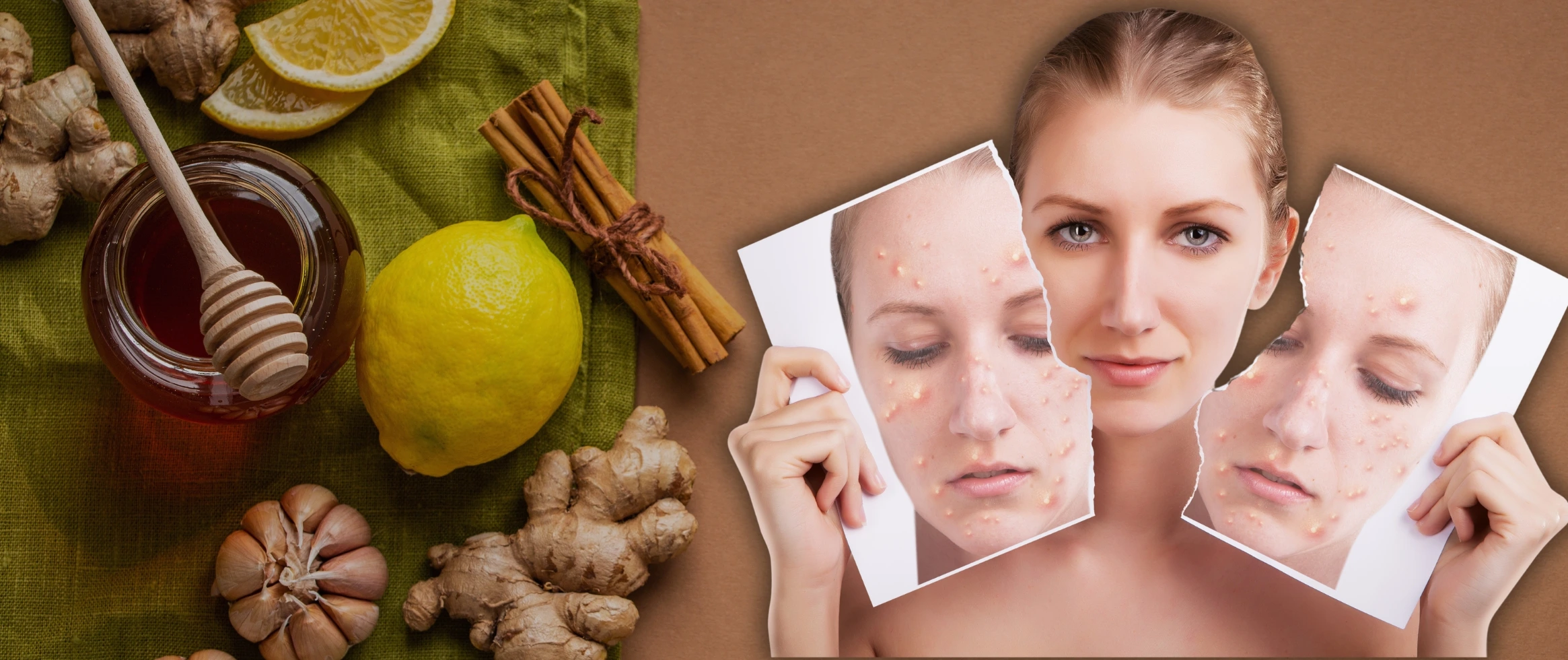 Say Goodbye to Pimples: 12 Effective Home Remedies for Acne