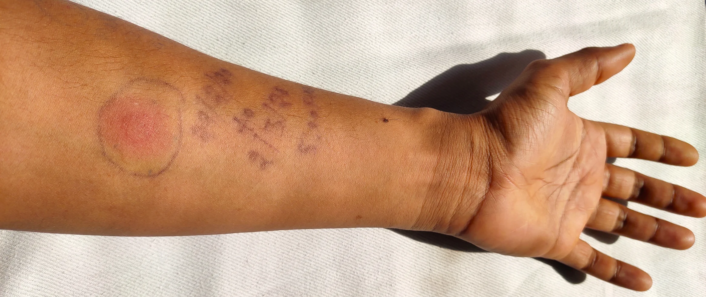 Tuberculin Skin Test: Normal Range, Procedure, and Results