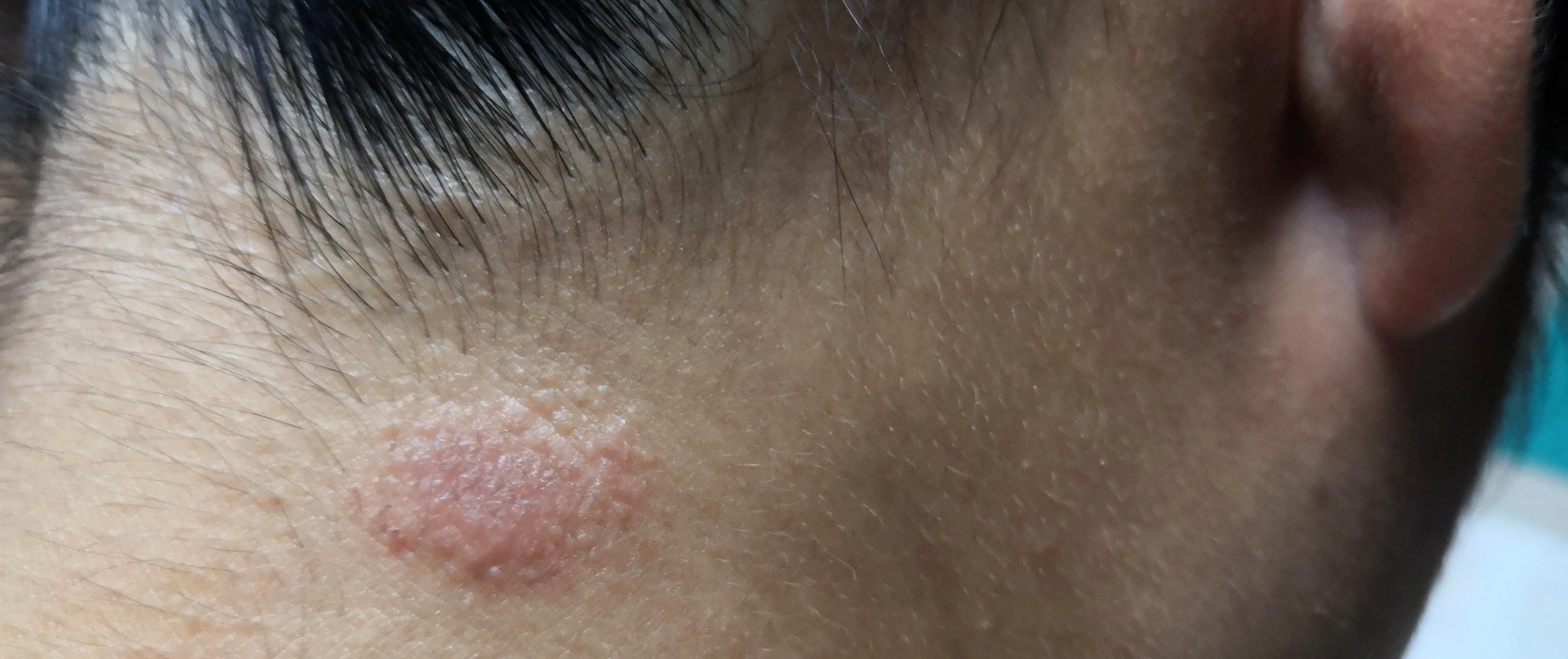 What Does Ringworm Look Like? Causes, Symptoms & Treatment Guide