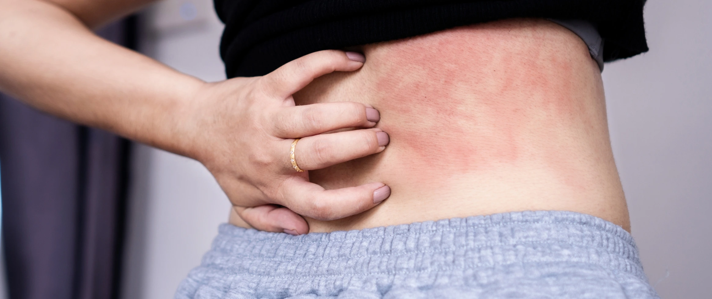 What Is the Reason of Red Itchy Patches on Skin